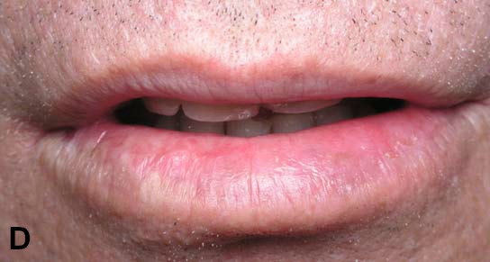 Skin Cancer Skin Cancer On Lip